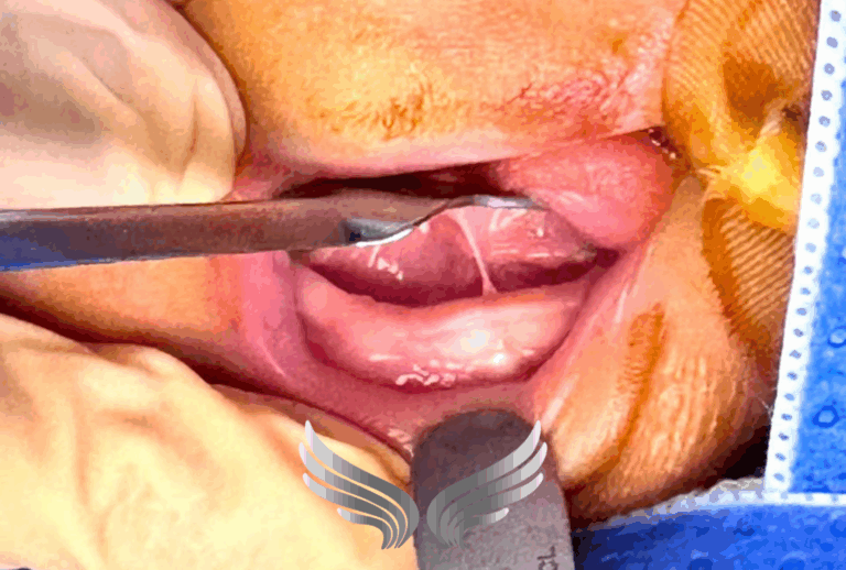 Frenillo sublingual corto: ¿Qué es y cuáles son sus problemas? - Dra ...
